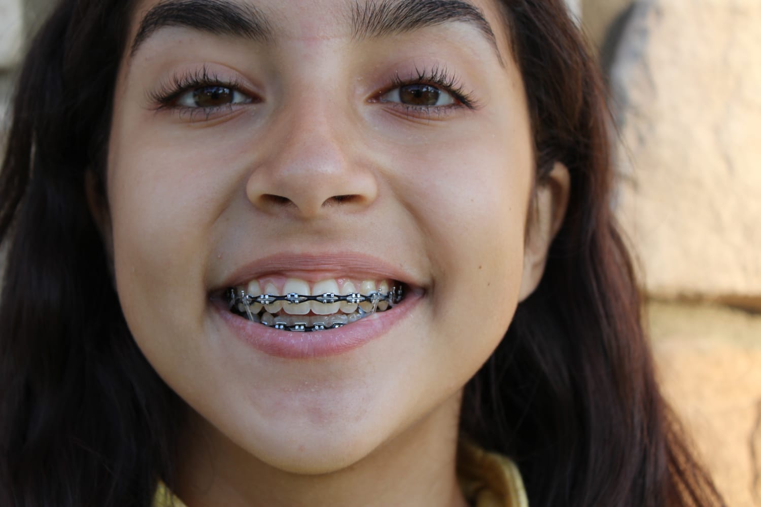 Types of braces Thurman Orthodontics Types of braces Thurman Orthodontics